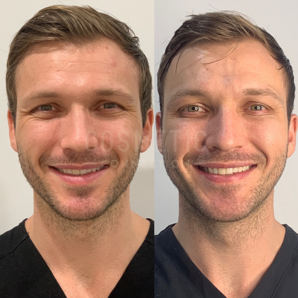 Men's Wrinkle Treatments Sydney & Melbourne | Cosmetic Connection | Non ...