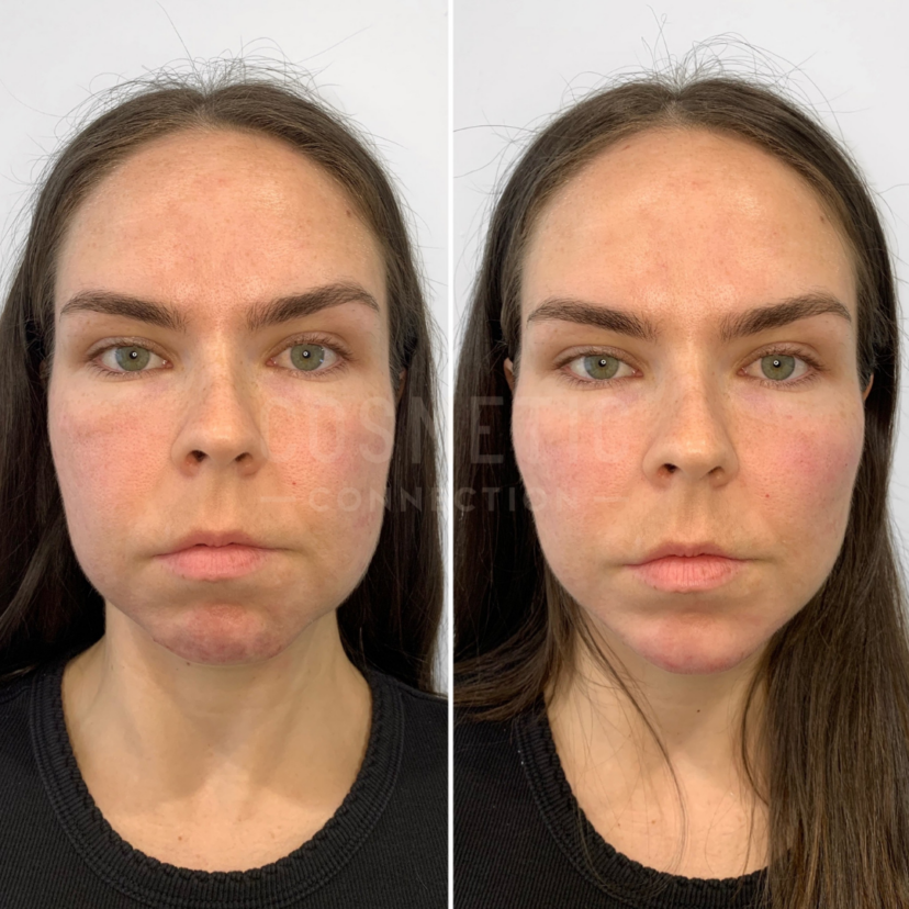 Facial Slimming Treatment - Cosmetic Connection