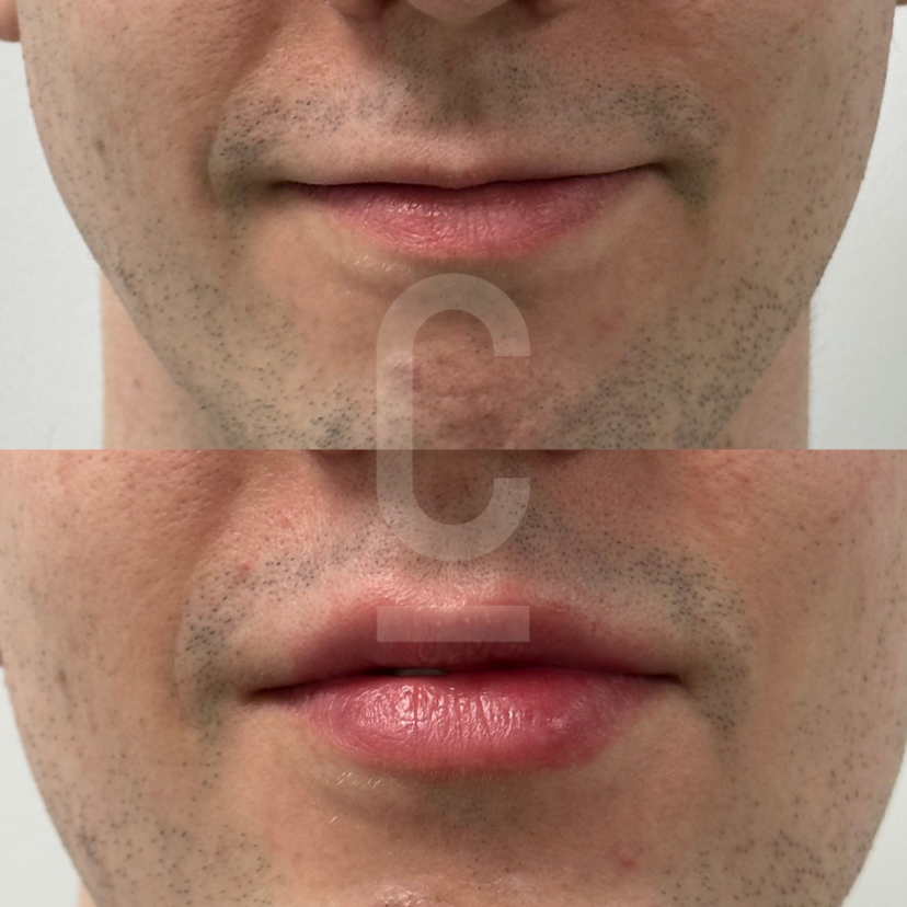 Lip Enhancement for Men: What to Expect | Complete Guide