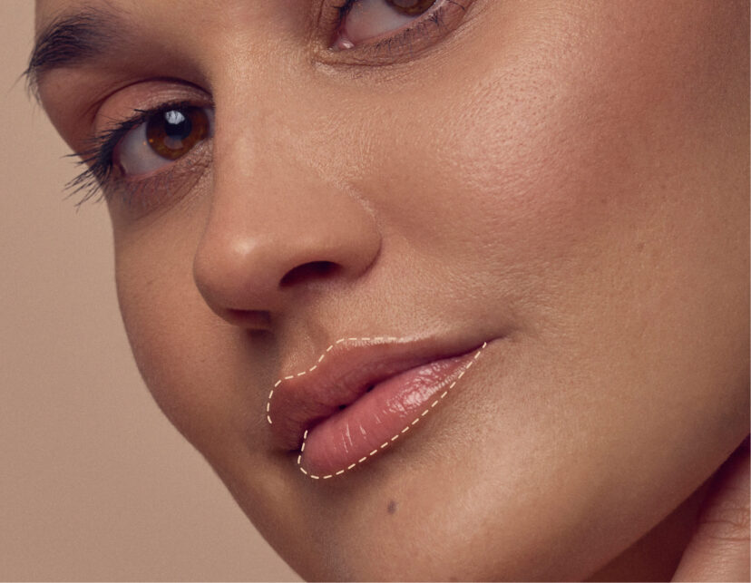 Non-Surgical Lip Augmentation | Lip Filler | Cosmetic Connection