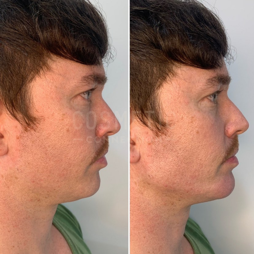 Masculinisation Filler Treatments | Non Surgical Injections