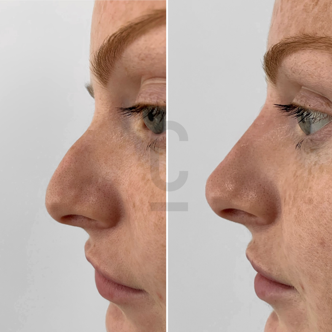 Non-surgical rhinoplasty before and after: what results are actually ...