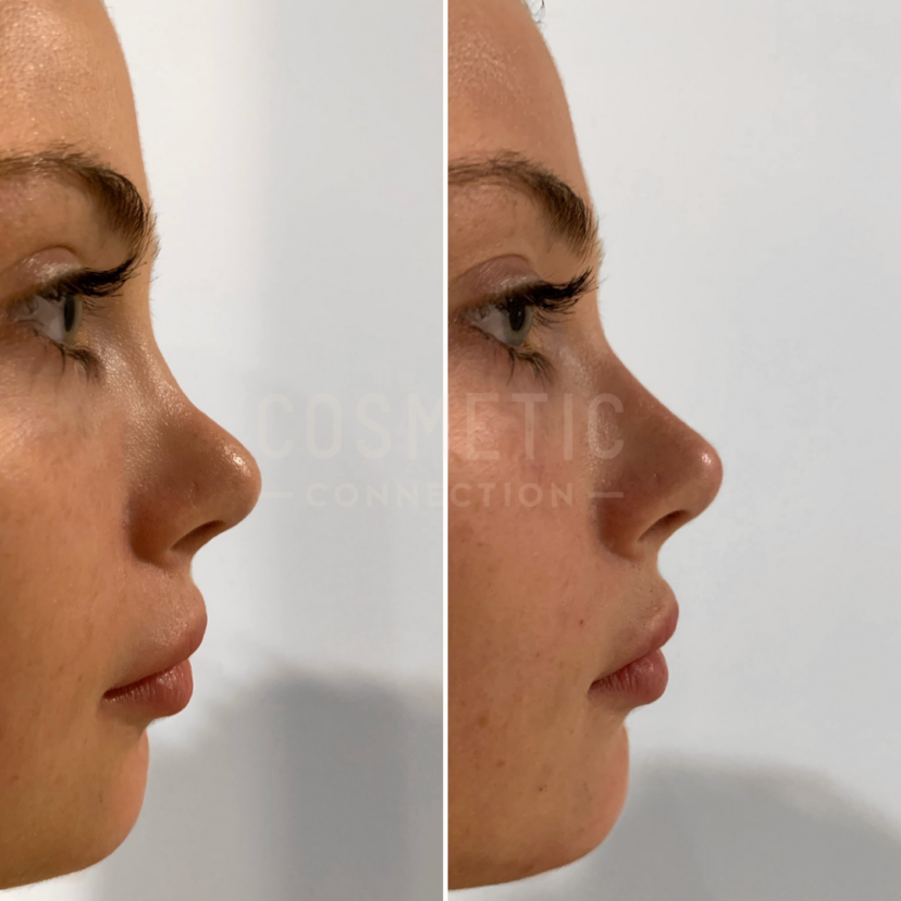 Dealing With Rhinoplasty Regret Cosmetic Connection
