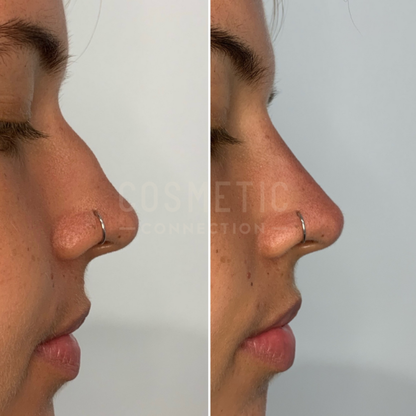Non-Surgical Nose Job: Liquid Rhinoplasty Guide