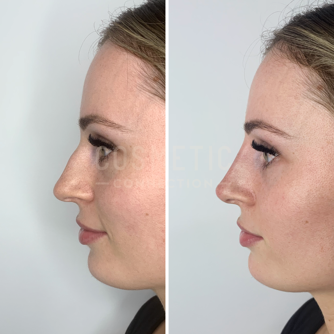 Non-Surgical Nose Job Explained - Cosmetic Connection
