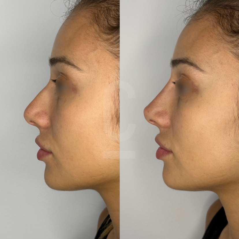 Non-Surgical Nose Jobs & Rhinoplasty Treatments | Cosmetic Connection