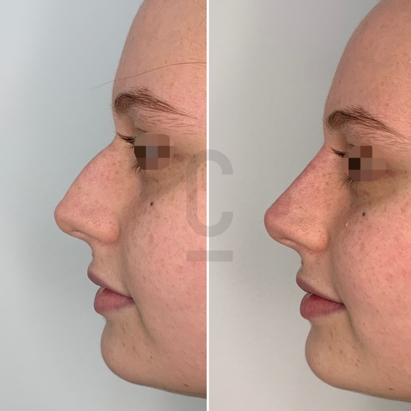 Understanding 3-Point Rhinoplasty - Cosmetic Connection