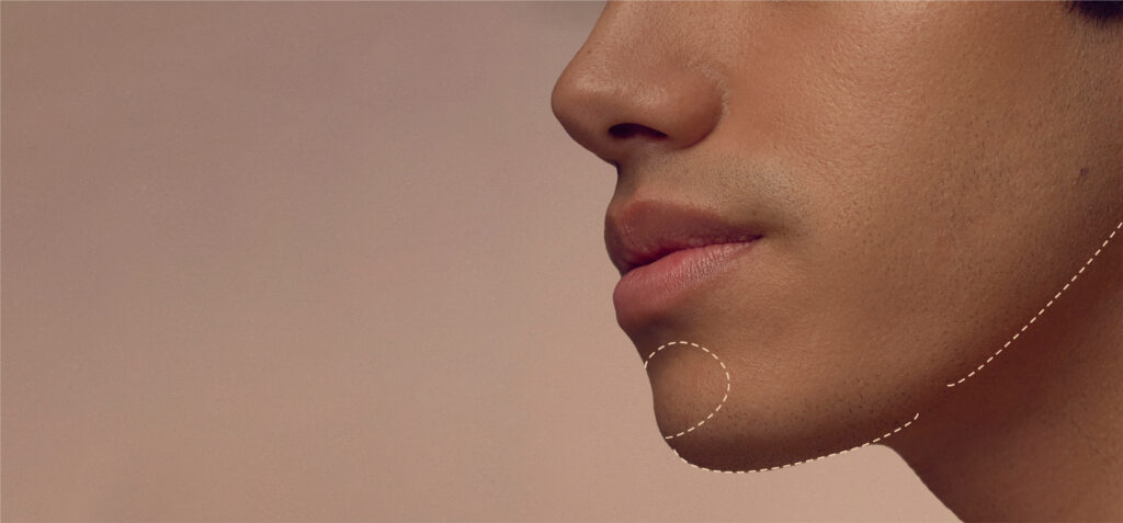 Double Chin Fat Treatment | Cosmetic Connection
