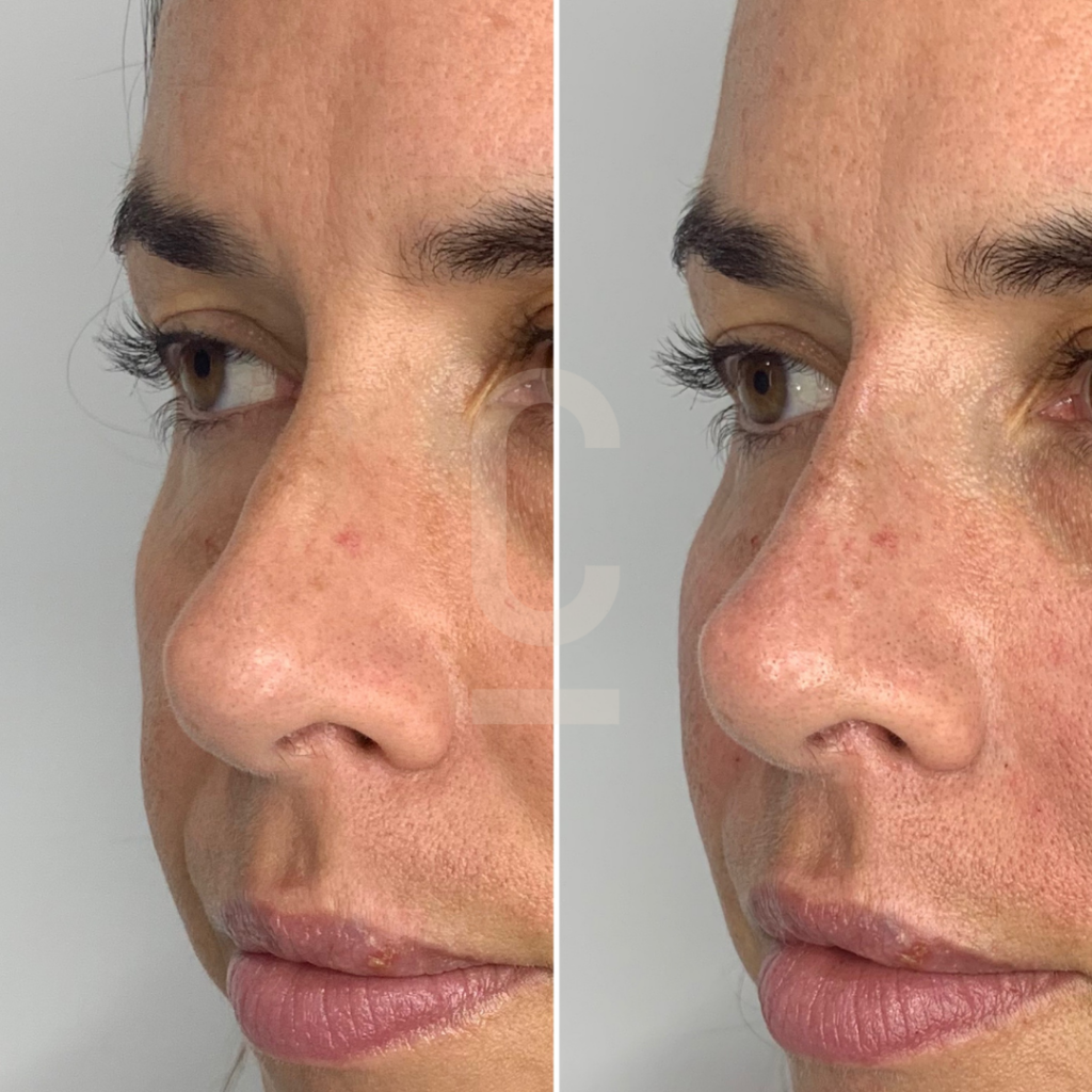Cheek Contouring: Non-Surgical Volume & Lift | Cosmetic Connection
