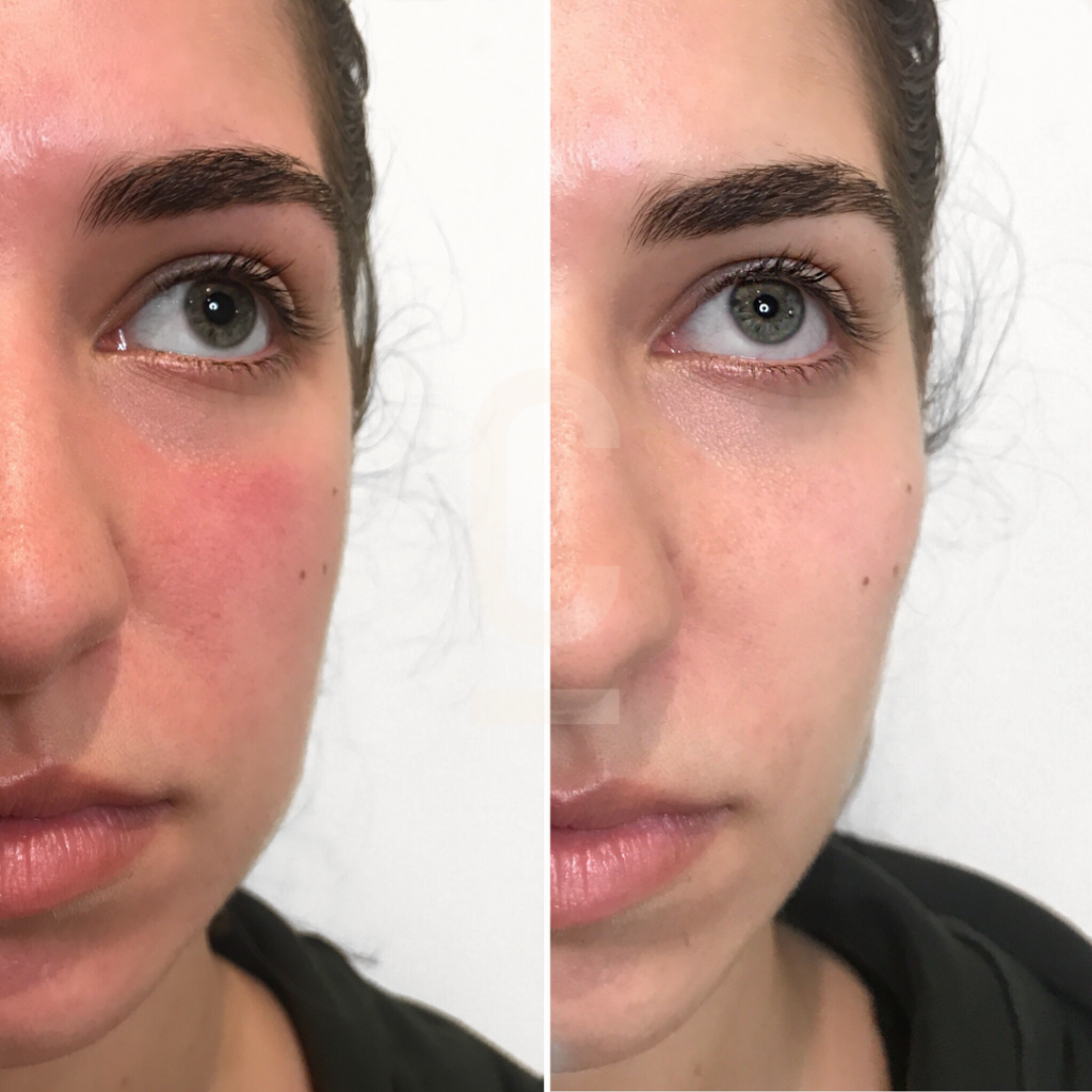 Cheek Contouring: Non-Surgical Volume & Lift | Cosmetic Connection