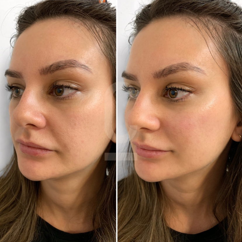 The comprehensive guide to cheek fillers - Cosmetic Connection