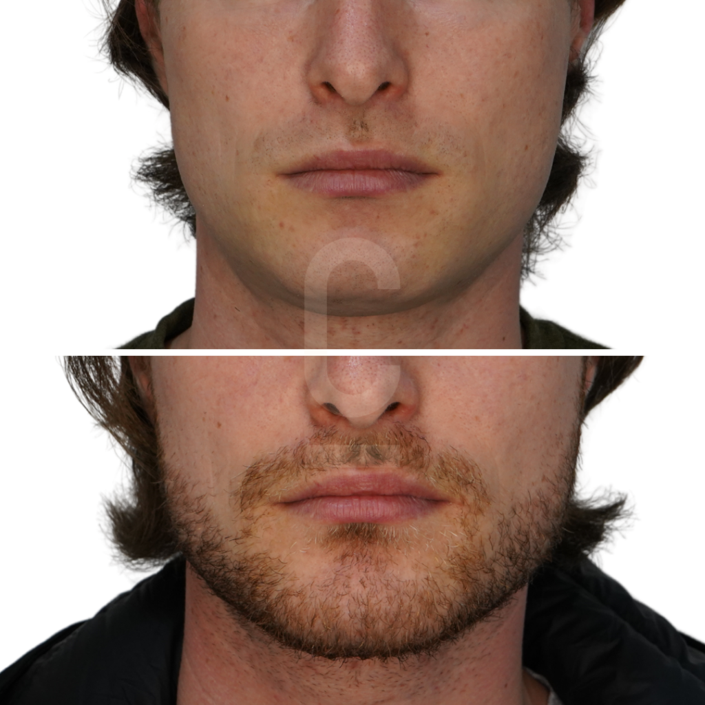 Chin Fillers Sydney | Non Surgical Injections