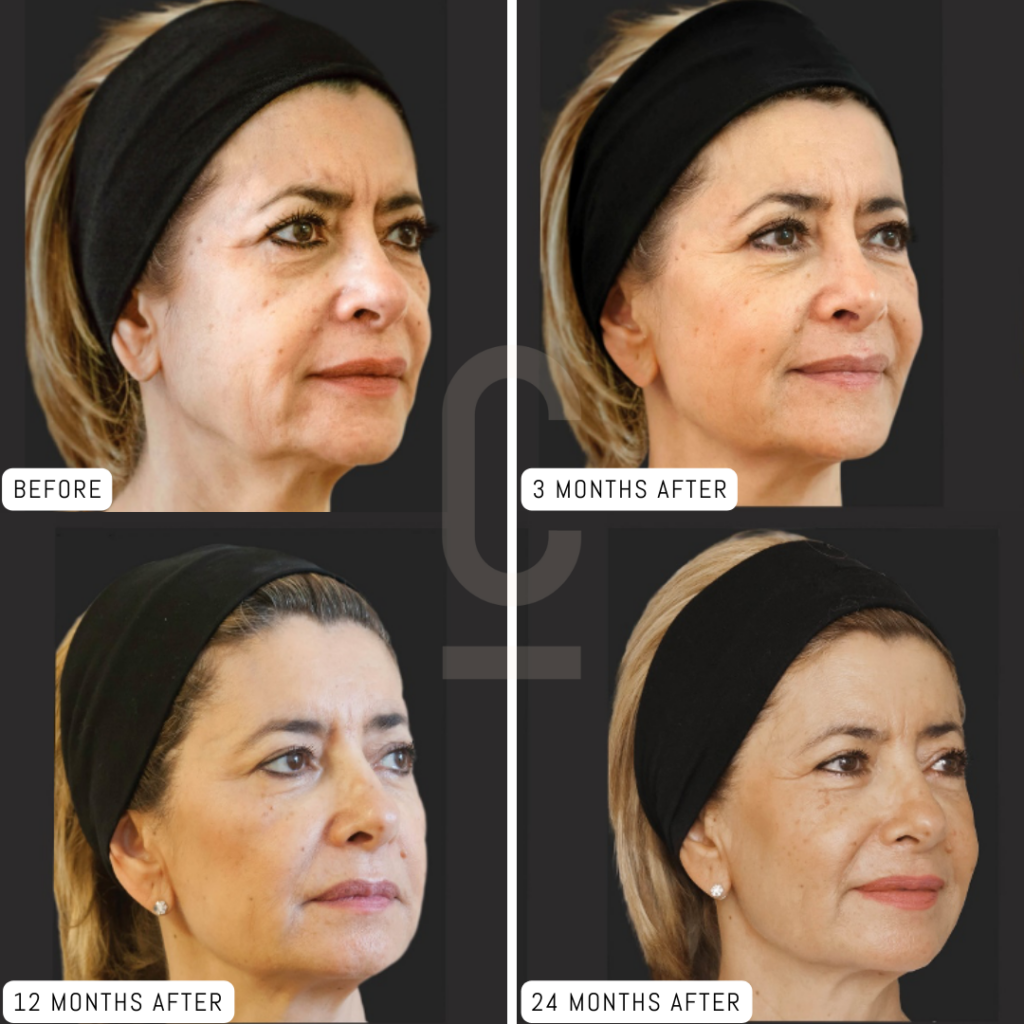 Collagen Stimulating Injections | Cosmetic Connection