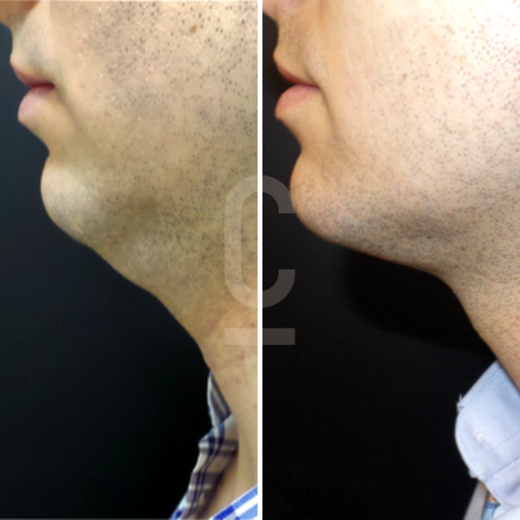 Double Chin Removal Treatment | Cosmetic Connection