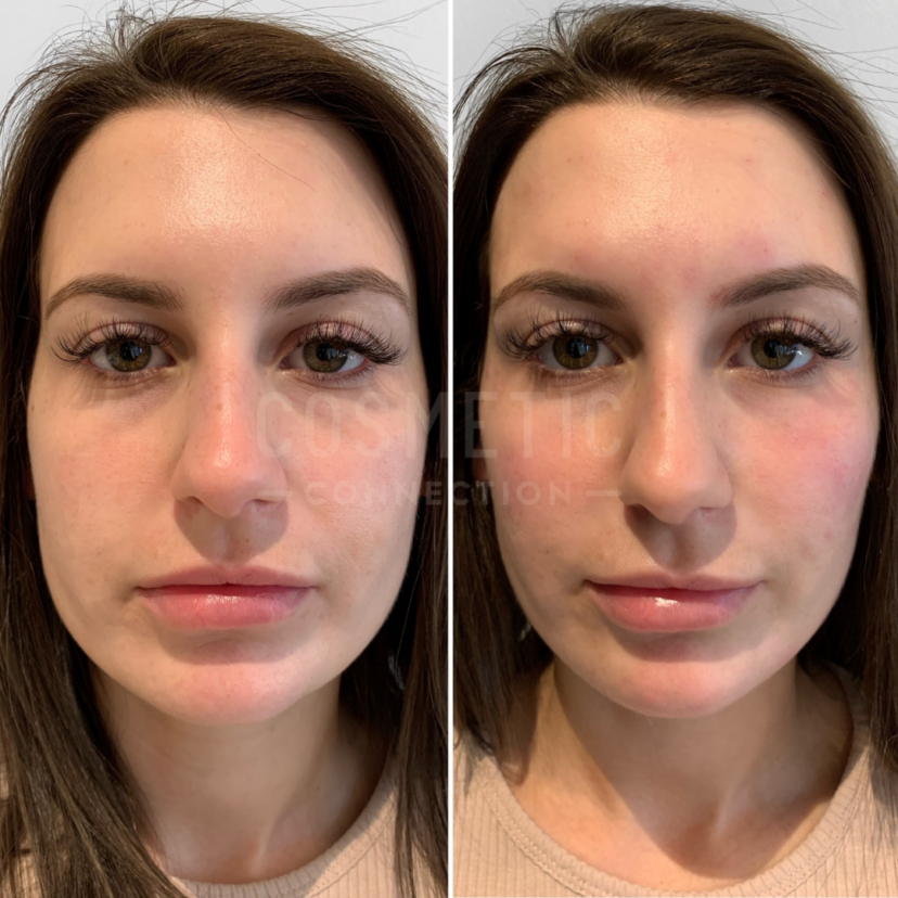 Facial Slimming Treatment - Cosmetic Connection
