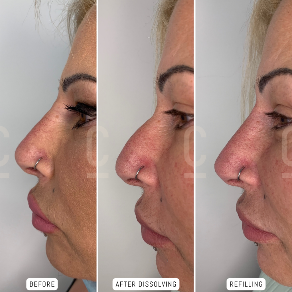 Filler Dissolving & Correction Sydney | Cosmetic Connection