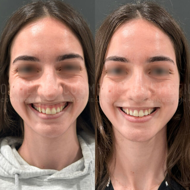 Gummy Smile Injection | Cosmetic Connection