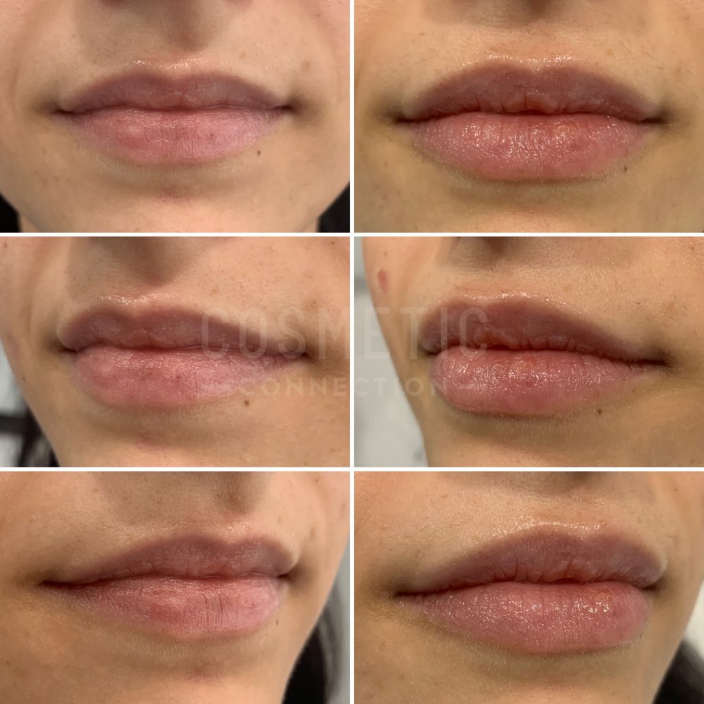 Choosing the Right Lip Filler Size | Cosmetic Connection