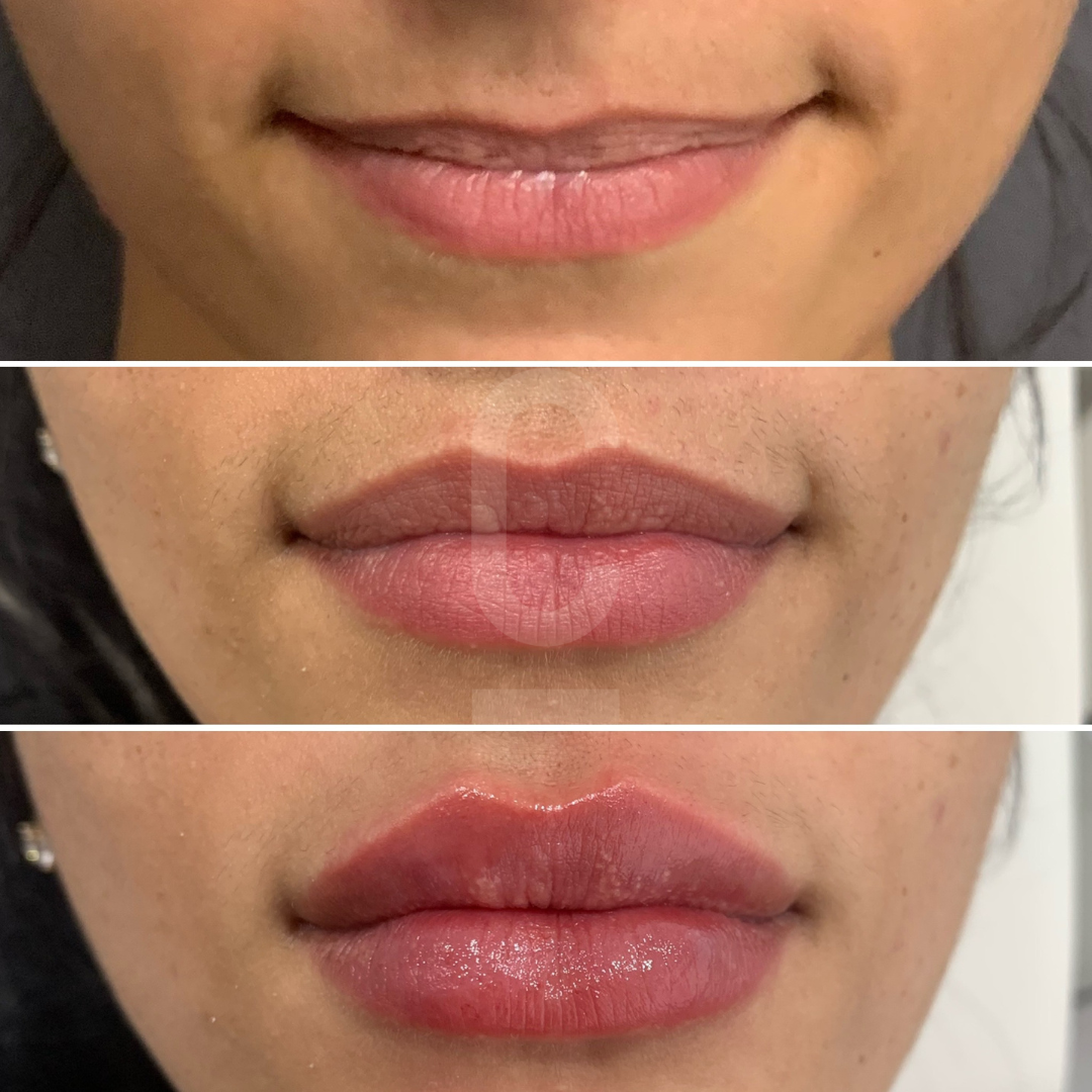 Lip Implant Sizes