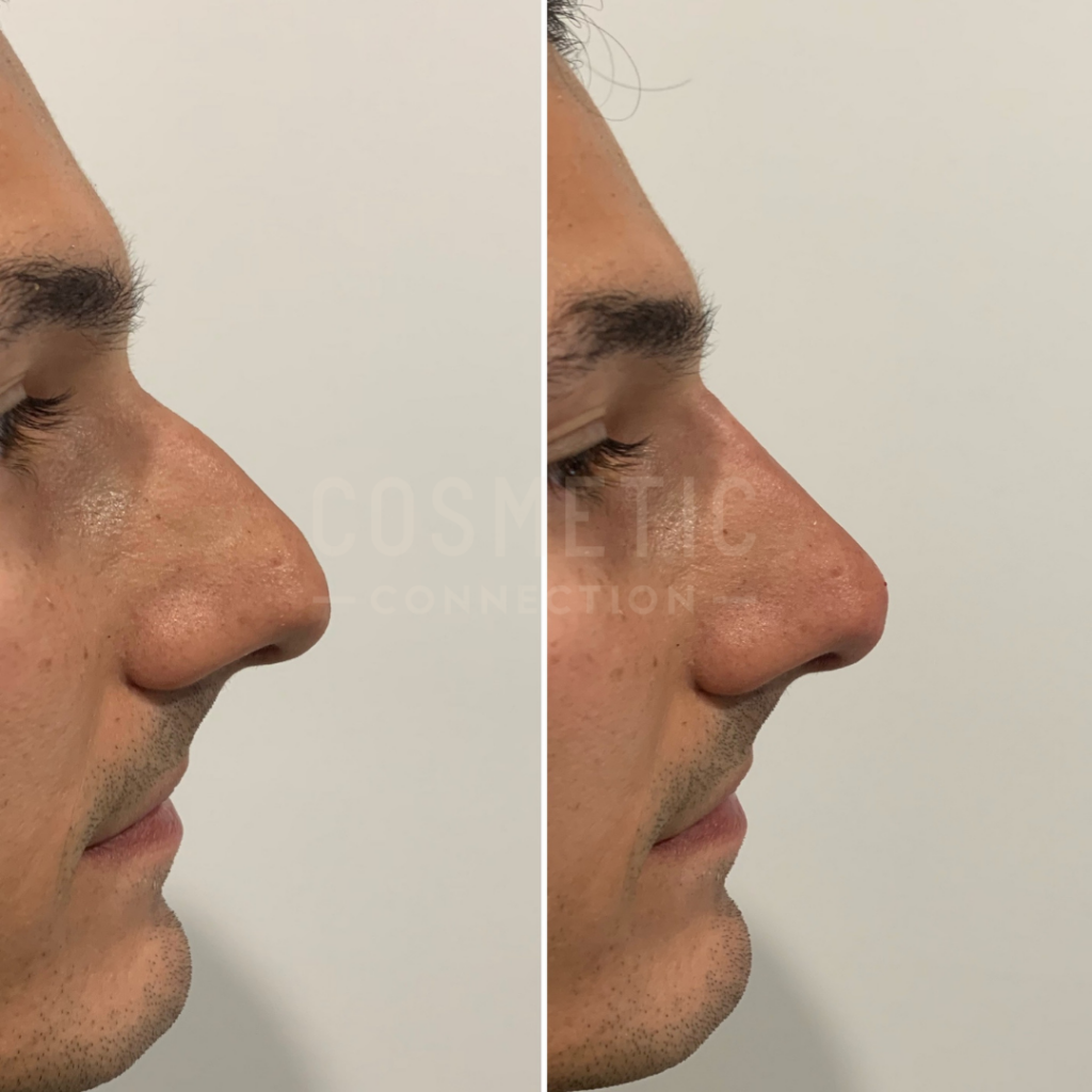 Nose Tip Lift Filler | Non-Surgical Tip Lift