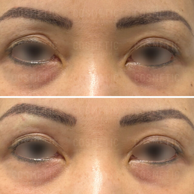 Upper Eyelid Exposure Treatment | Cosmetic Connection