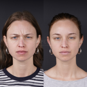 Frown Lines Treatment Guide | Cosmetic Connection