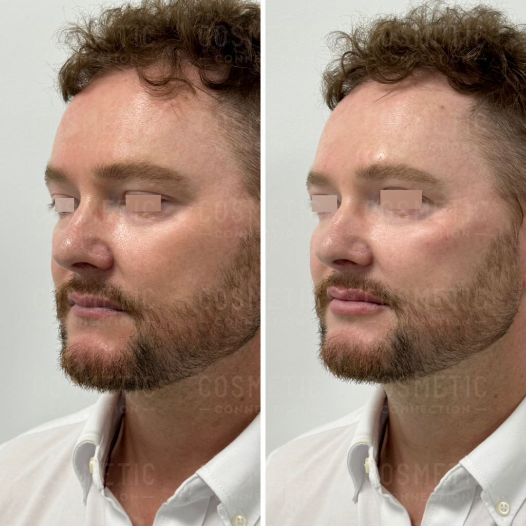 Cheek Contouring: Non-Surgical Volume & Lift | Cosmetic Connection