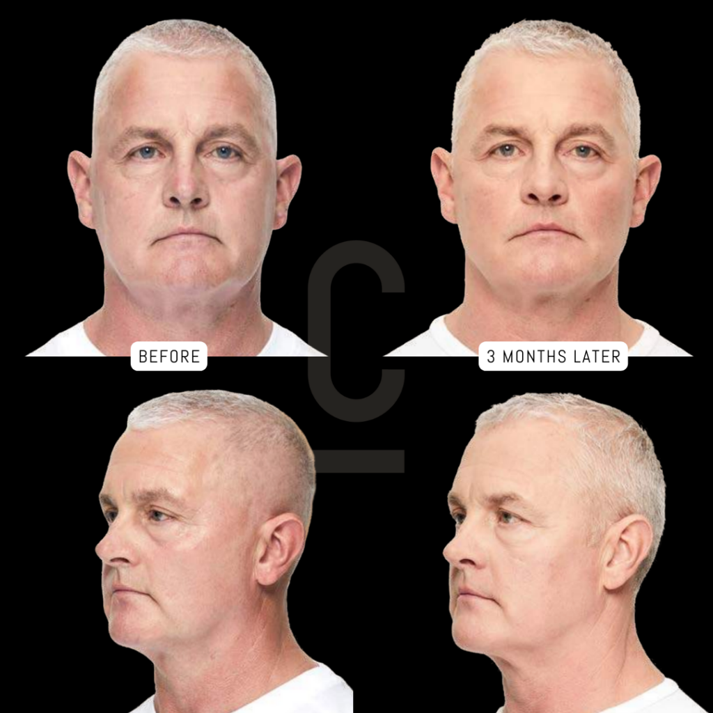 Collagen Stimulating Treatments | Cosmetic Connection