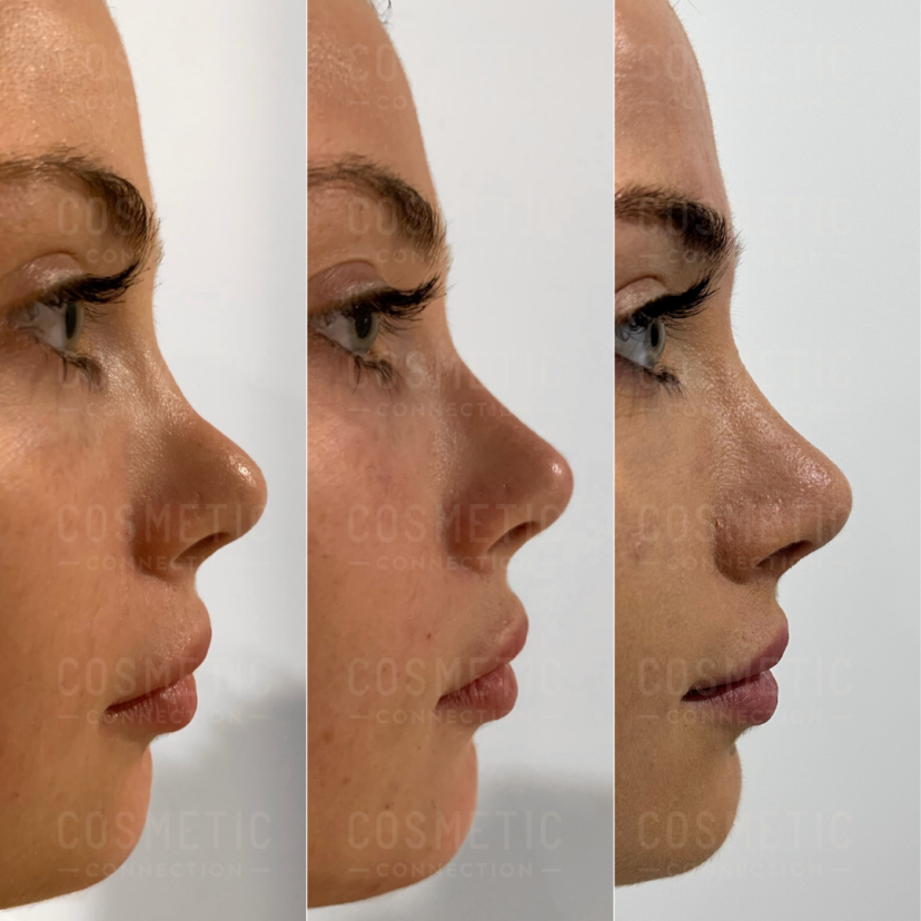 Correcting Failed Rhinoplasty with Dermal Fillers
