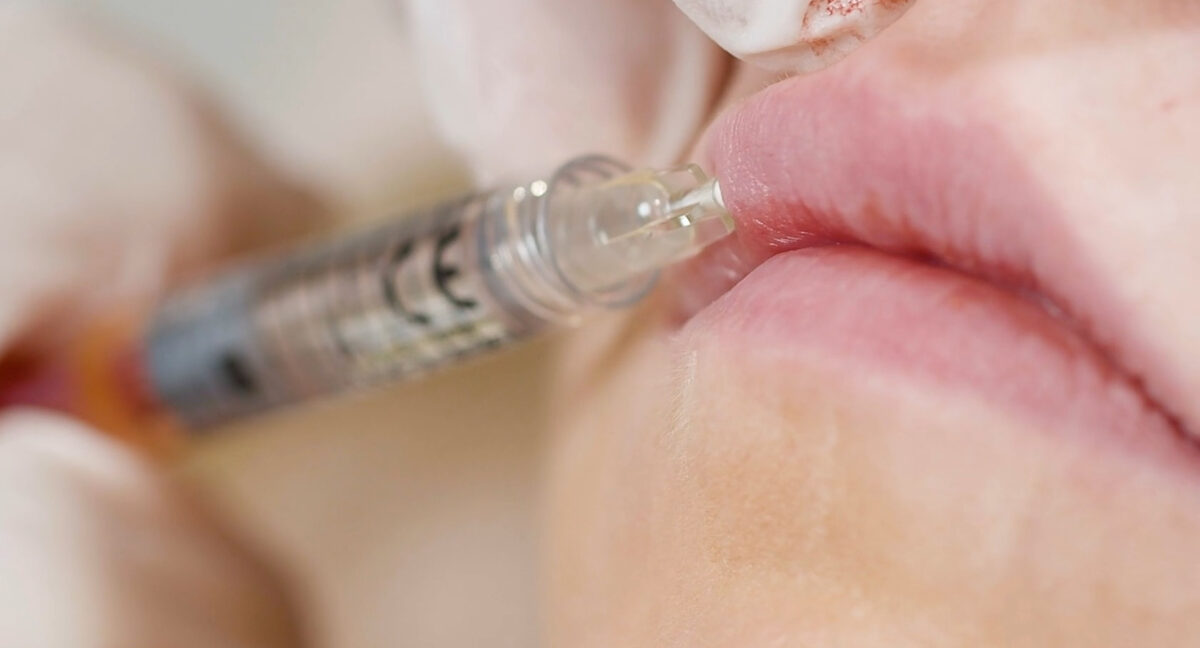 Understanding Post Lip Filler Lumps Cosmetic Connection
