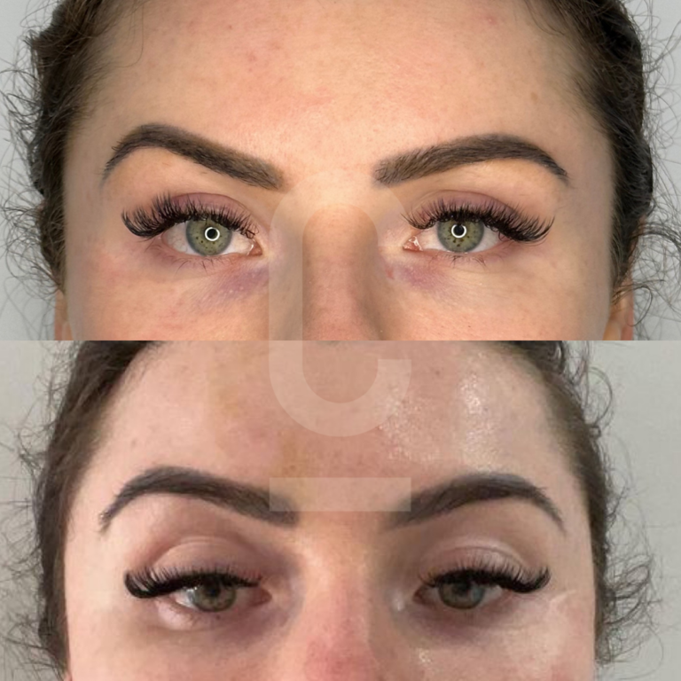 Non Surgical Brow Lift | Cosmetic Connection