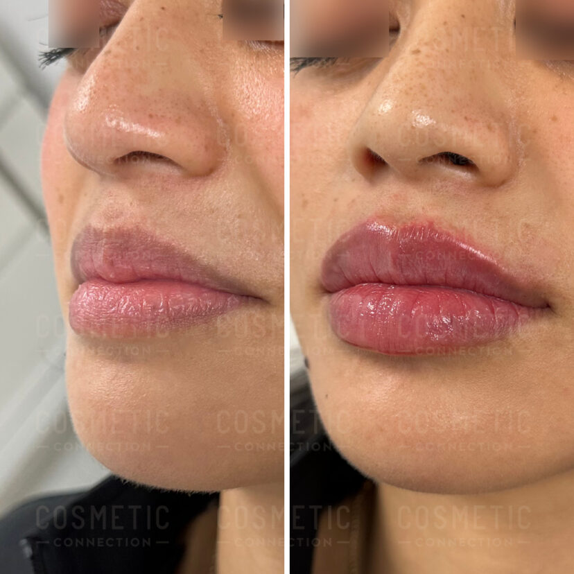 Lip Fillers Cosmetic Connection