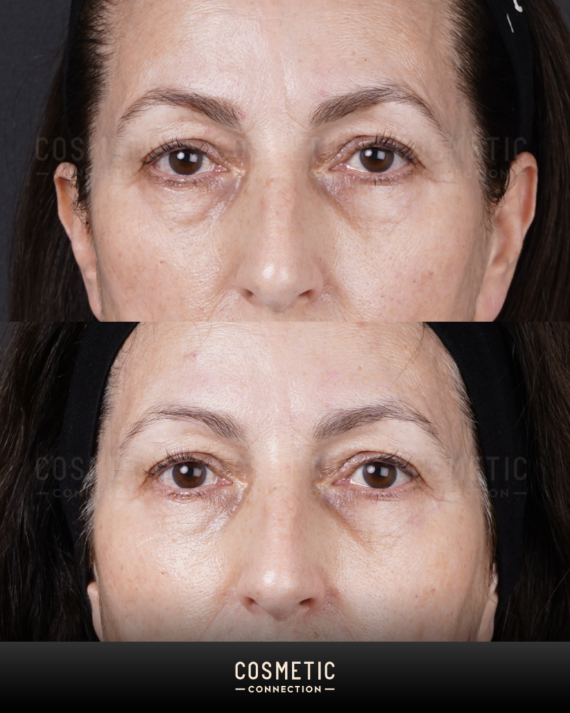 Rejuran Results Guide & Before & After Photos | Full Face, Eyes, Lips ...