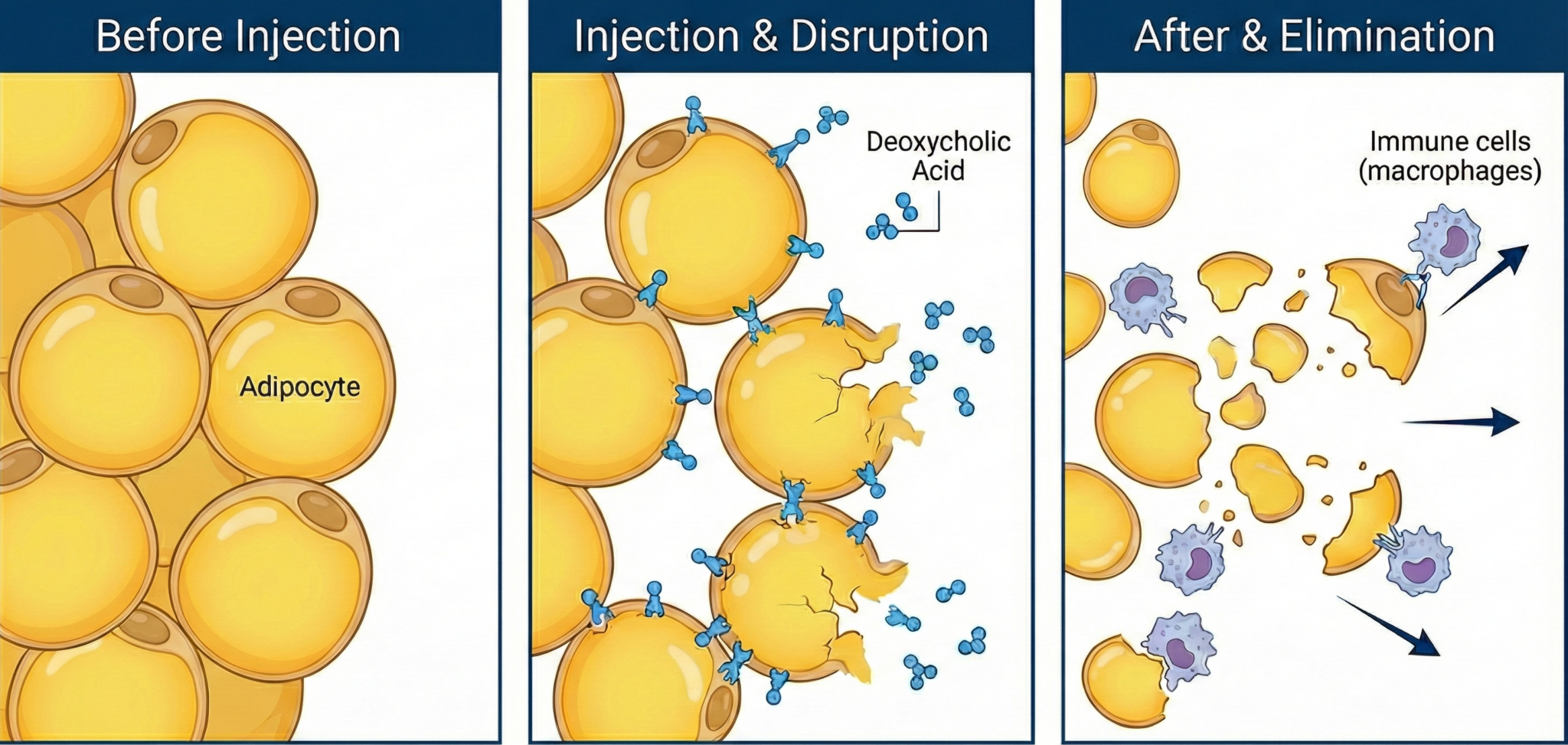 Under Chin Fat Dissolving Injections: How They Work & What to Expect